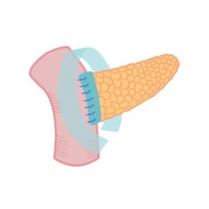 NEOVEIL™ - Europrisme Médical Groupe