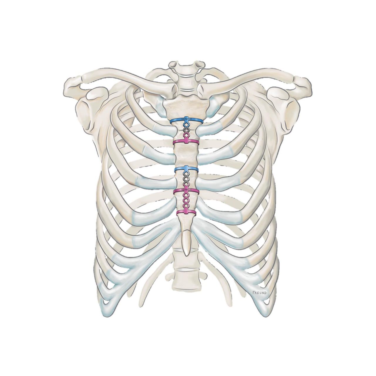 AGRAFES STERNALES STRATOS™ - Europrisme Médical Groupe
