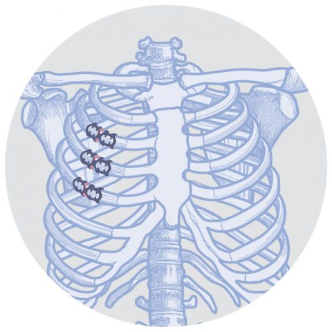 NITIRIB - Europrisme Médical Groupe