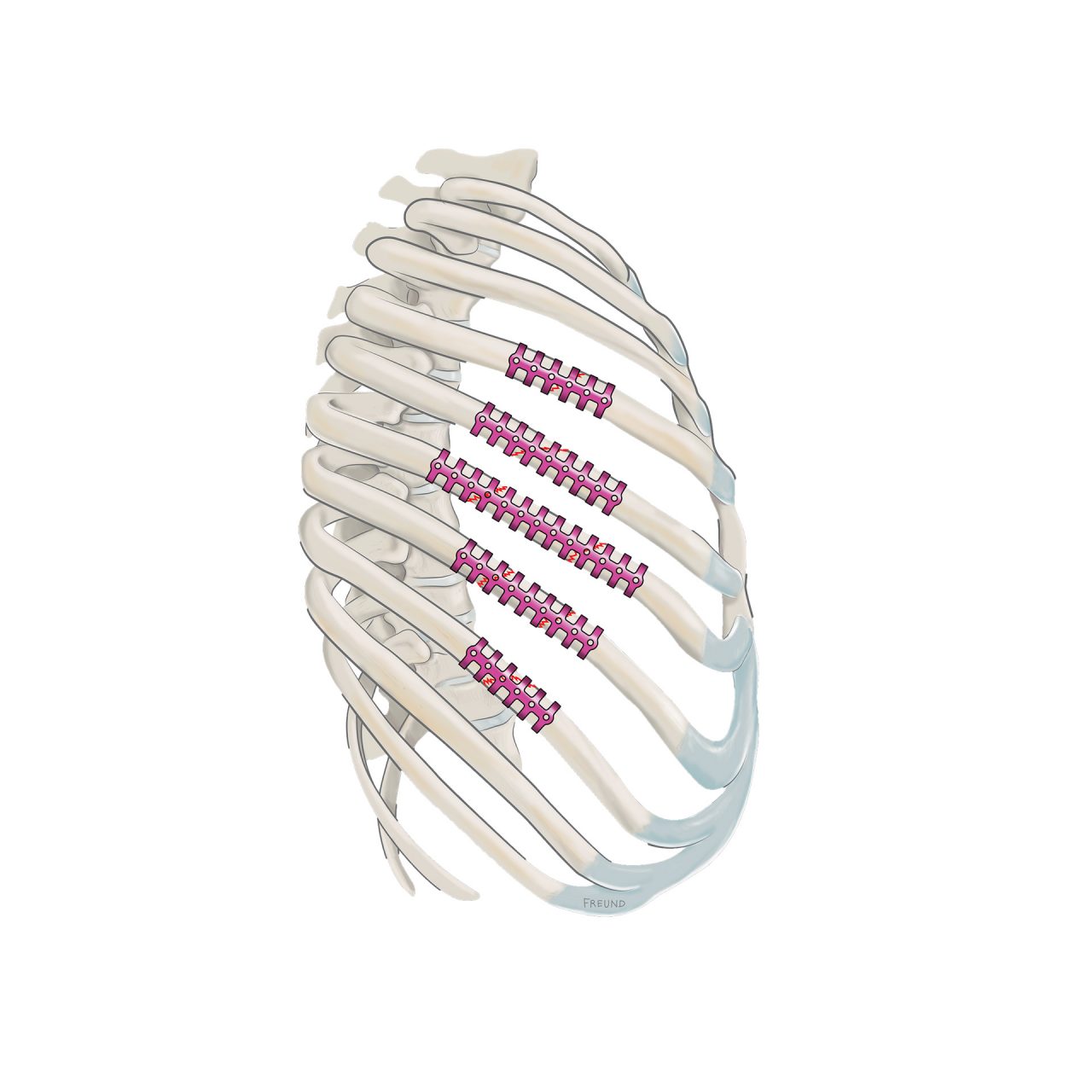 STRACOS™ - Europrisme Médical Groupe