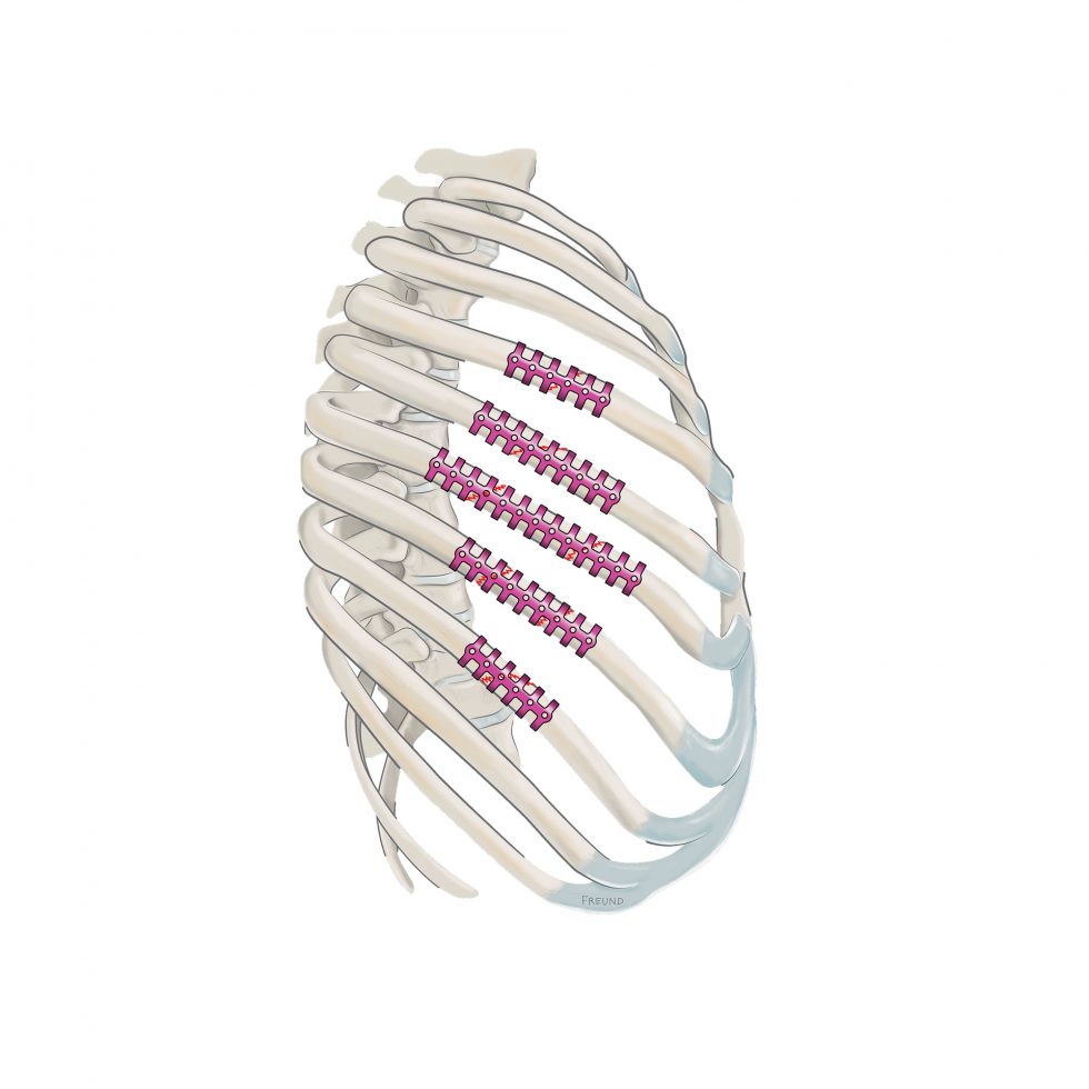 STRACOS™ - Europrisme Médical Groupe